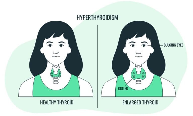 What is hypothyroidism? - FITPAA
