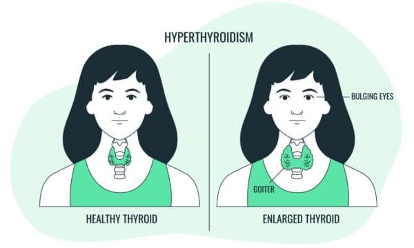 How is hyperthyroidism treated? - FITPAA